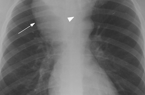 Left & Right Paratracheal Mass Symptoms, Causes, Treatment
