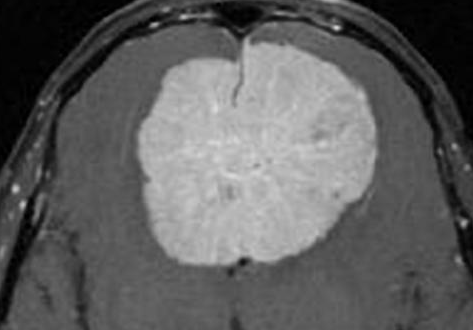 Parasagittal Meningioma Meaning, Symptoms, Causes, Treatment